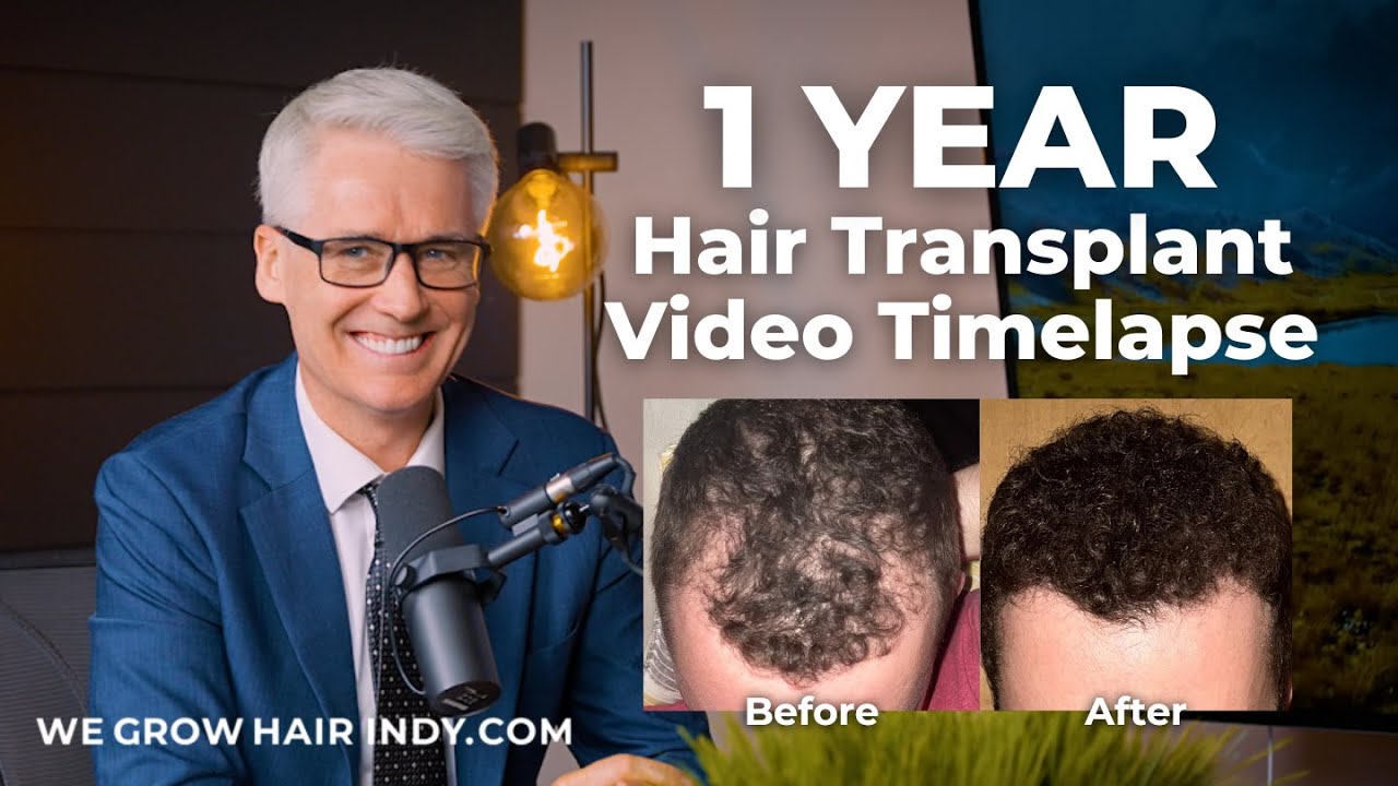 Hair Transplant 1 Year Video Timelapse We Grow Hair Indy Youtube