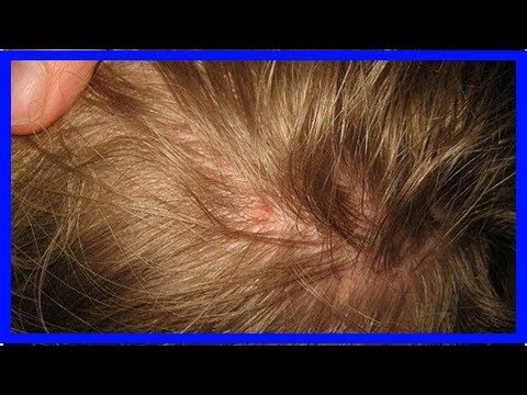 Läuse in den Haaren! Was kann ich tun? - YouTube