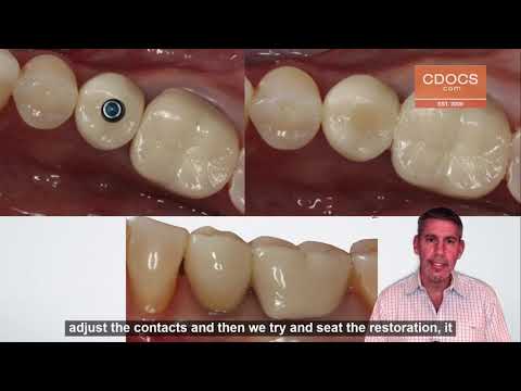 Tip of the Day: Screw Retained Crown - YouTube