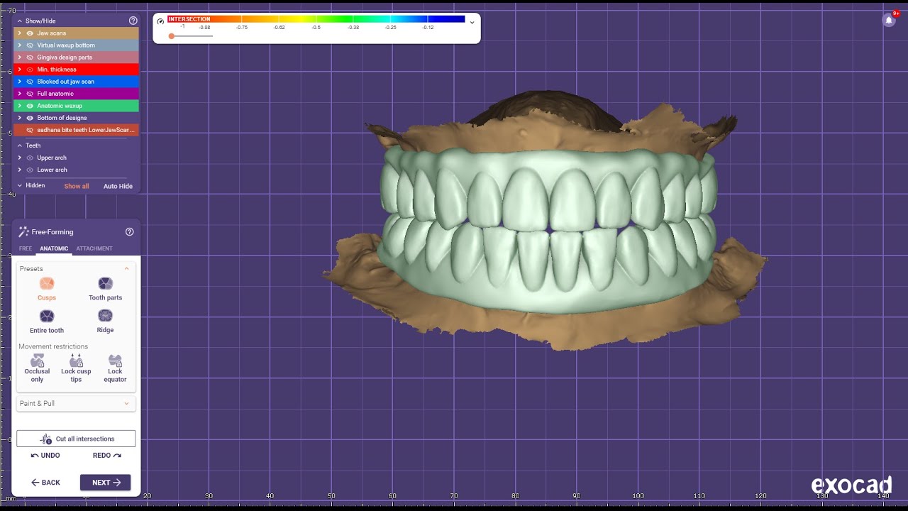 On substructure designing for upper & lower full arch in Exocad ...