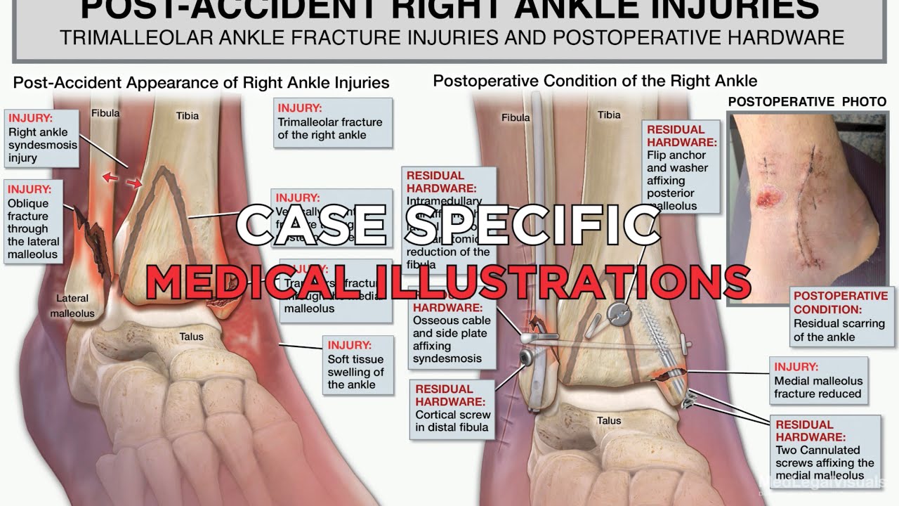 Medical Legal Illustration for Injury Cases - MedLegalVisuals® - YouTube
