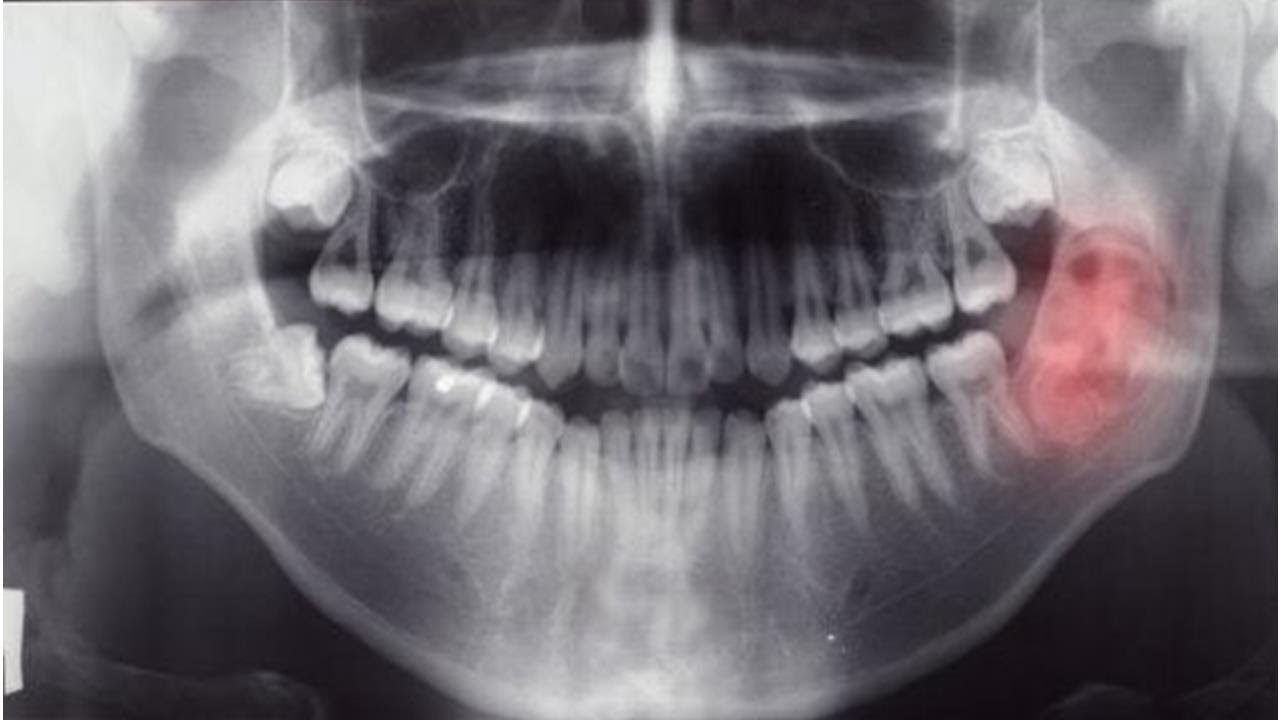 Diagnóstico de los tumores y quistes mandibulares | Maha TV - YouTube