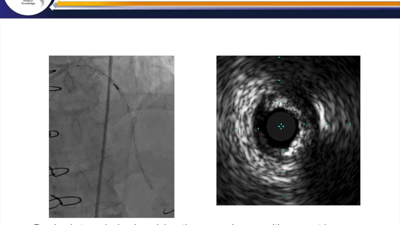 The Use of IVUS in PCI Involving Diffuse or Long Lesions - YouTube