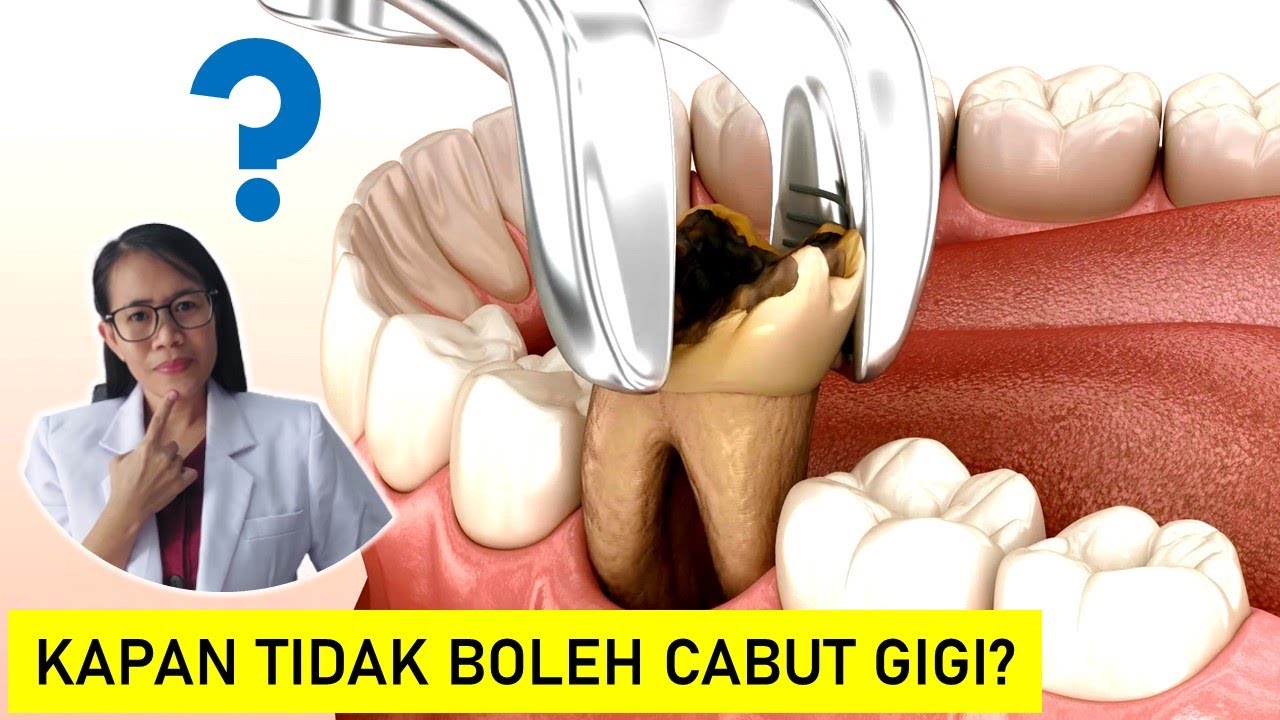Kapan tidak boleh cabut gigi ? - YouTube