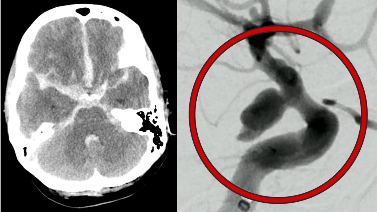 (English) Acutely ruptured ICA aneurysm (SAH); treatment with ...