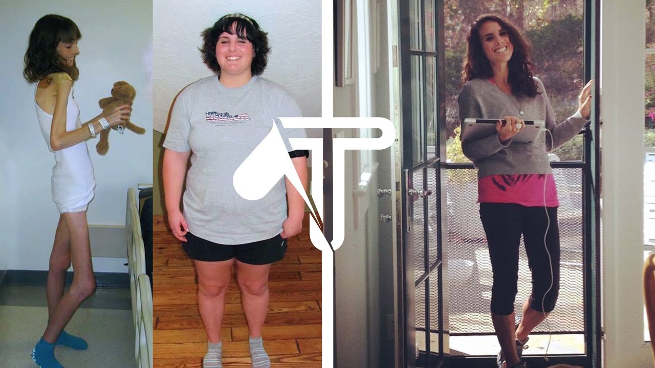 Anorexia Before And After Weight Loss Real Anorexic People