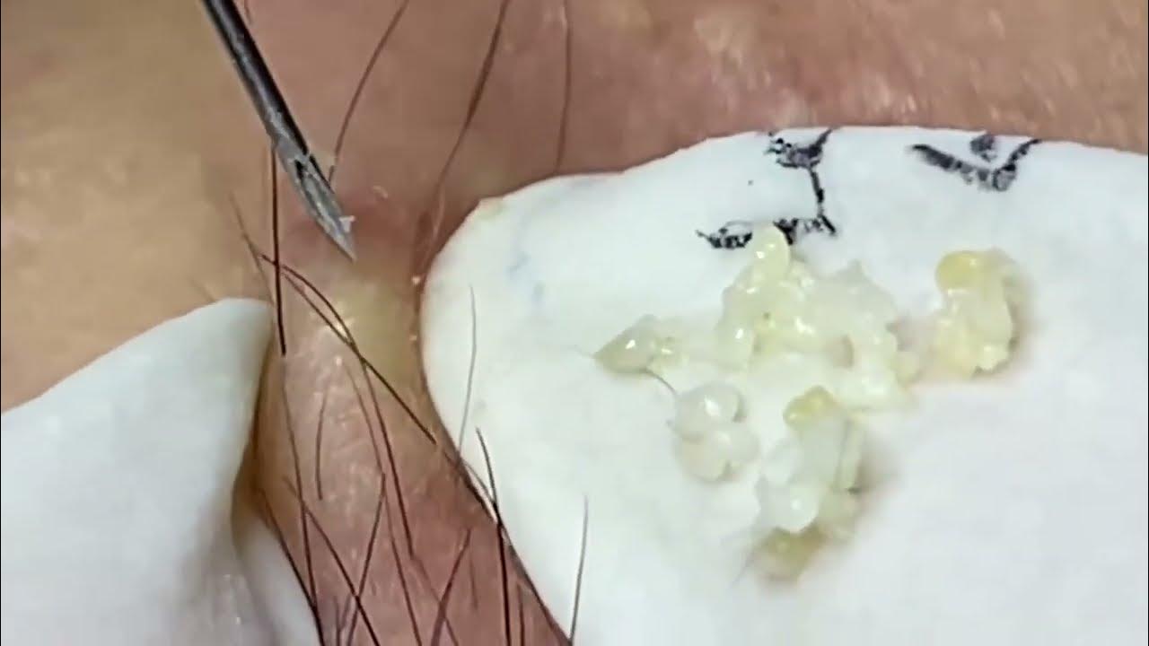 Acne Blackheads Whiteheads Removal Blackhead Extraction Enilsa Brown Youtube