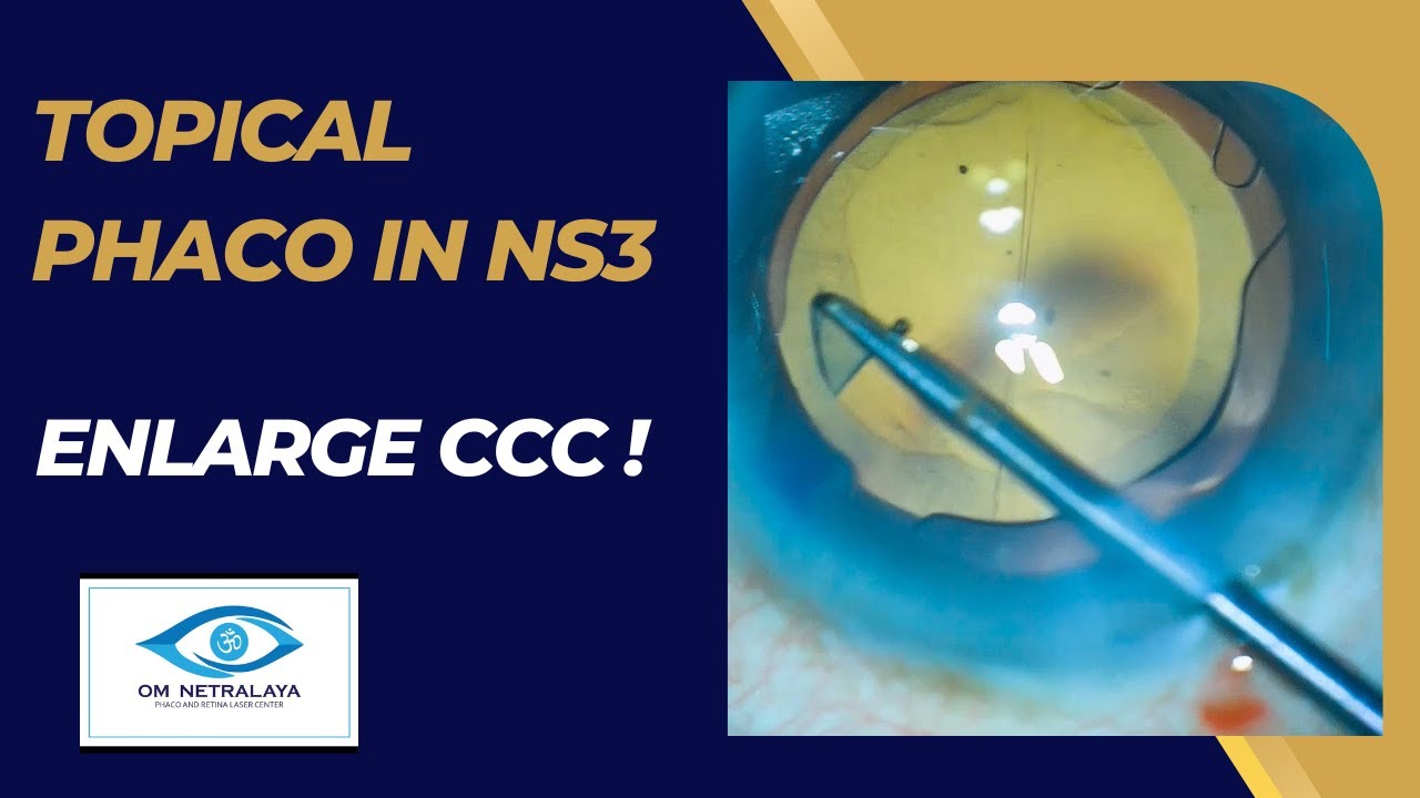 Case series 36. Enlarge CCC , Temporal topical phaco in NS3 grade ...