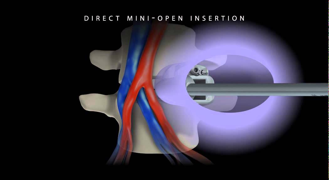 ROI-A Oblique ALIF Cage - YouTube