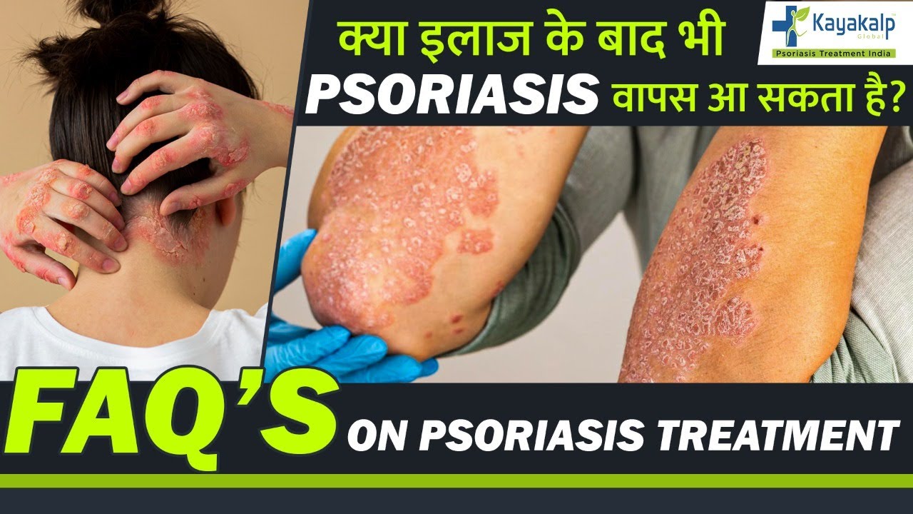 क्या इलाज के बाद भी psoriasis वापस आ सकता है? | FAQs on Psoriasis ...