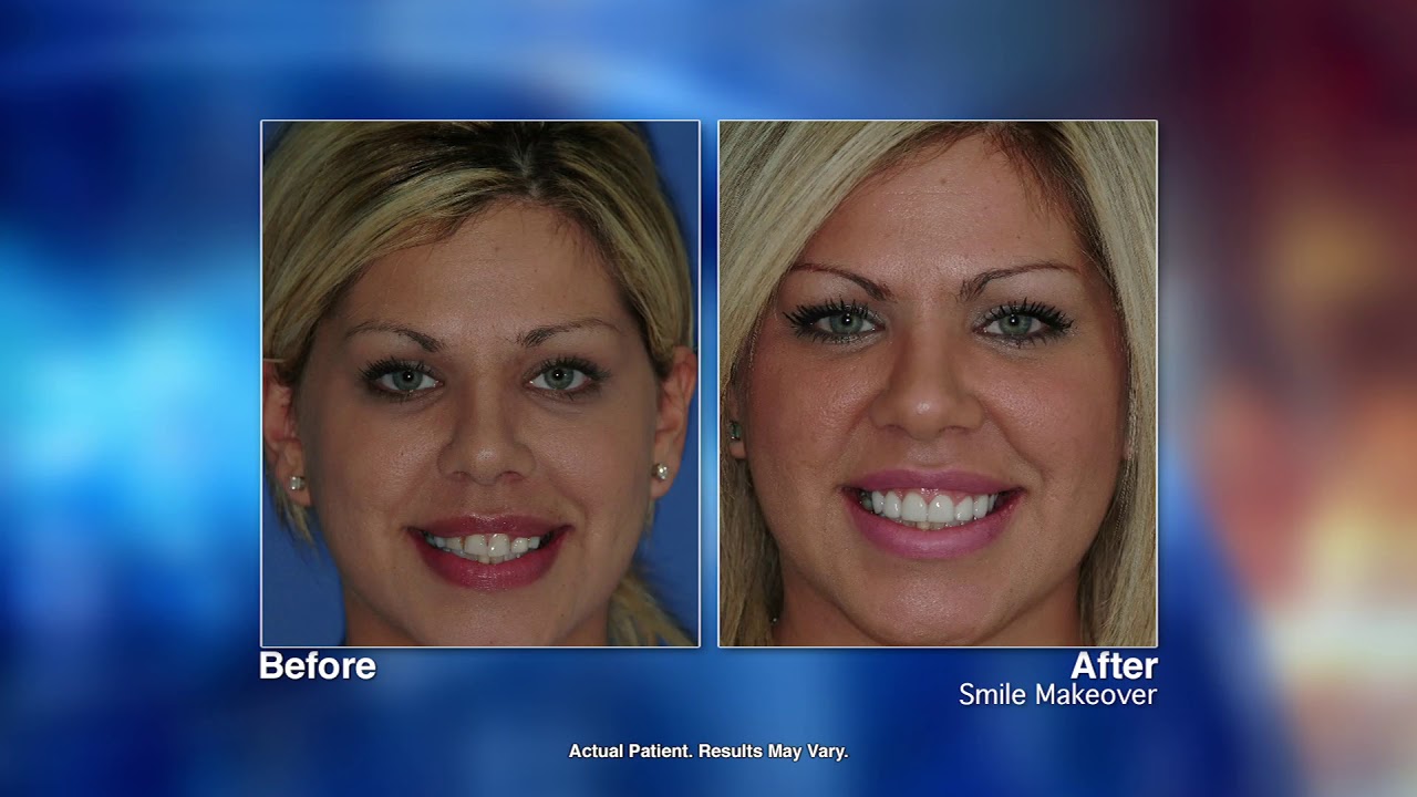 Extreme Smile Makeovers with Wilmette, IL Dentist Dr. Dino Mantis - YouTube