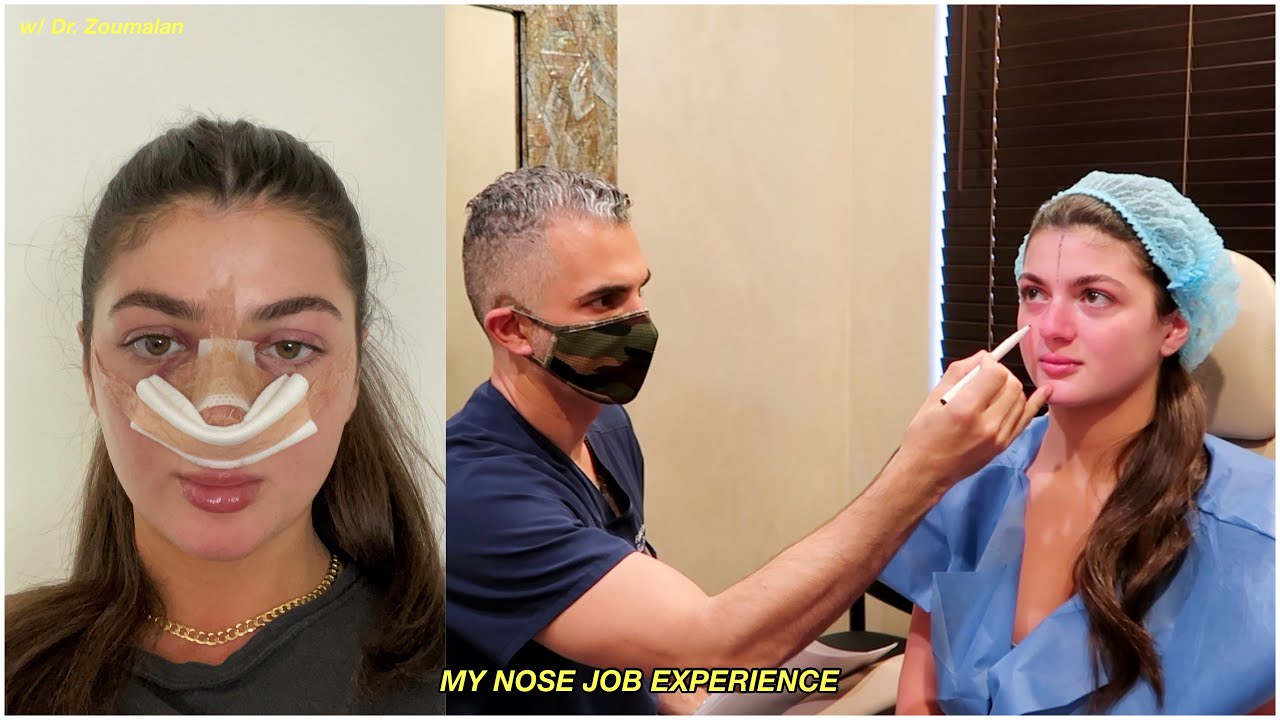 I FLEW ACROSS THE U S TO GET A NOSE JOB My Experience part 1 YouTube i-flew-across-the-u-s-to-get-a-nose-job-my-experience-part-1-youtube