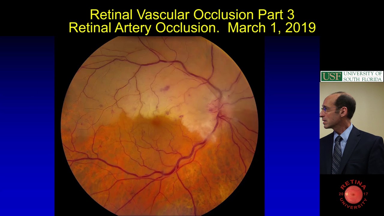 Retinal Artery Occlusion - YouTube