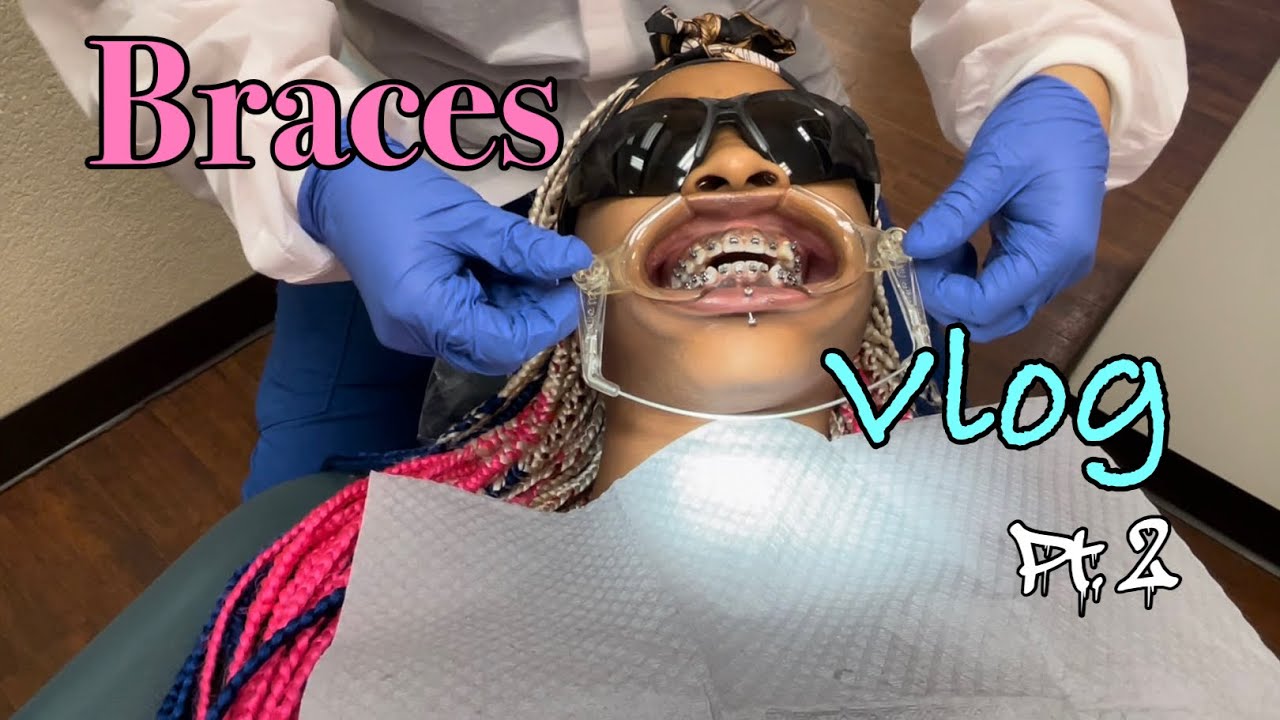 vlog: GETTING BOTTOM BRACES😬| top teeth tightened, broken brackets , etc - YouTube