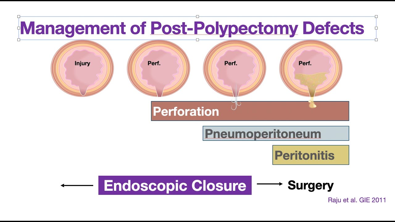 2025 DDW-ASGE-AGA Postgraduate Course-Polypectomy Perforation Closure ...
