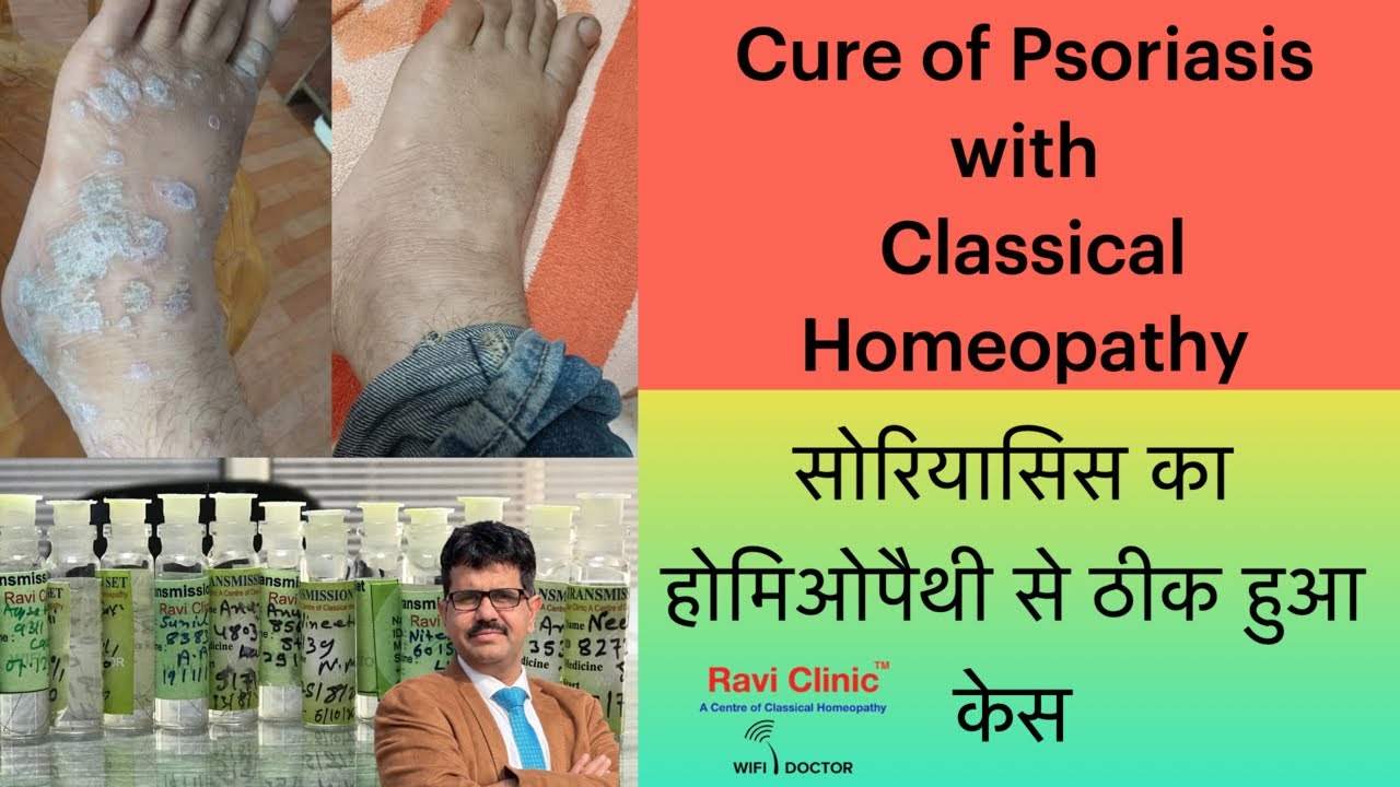 A case of Psoroasis healed with homeopathy Dr Ravi Singh - YouTube