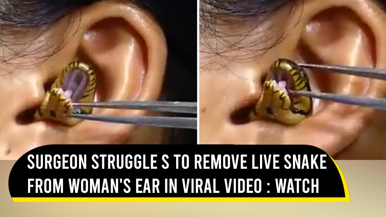 Surgeon struggles to remove live snake from woman’s ear in viral video ...