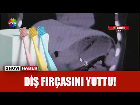 Kilo almamak için 13 santimlik diş fırçasını yuttu!