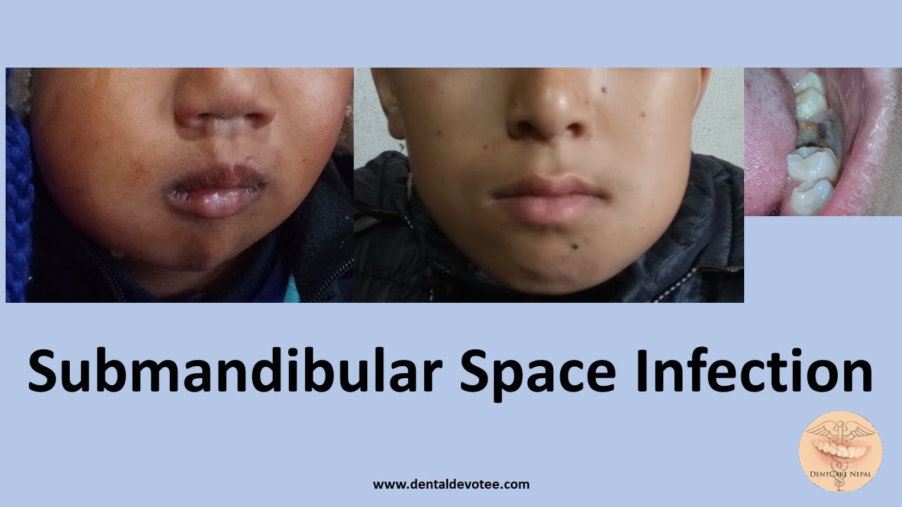 Submandibular Abscess