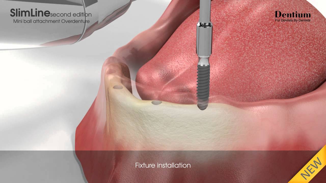 SlimLineSE miniball attachment overdenture - YouTube