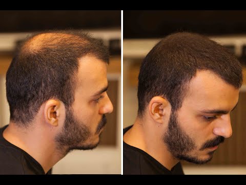 FİXDEEP Saç Dolgunlaştırıcı | Fixdeep Saç Tozu ile 30 Saniyede Seyrek Saçlara SON! Nasıl Uygulanır