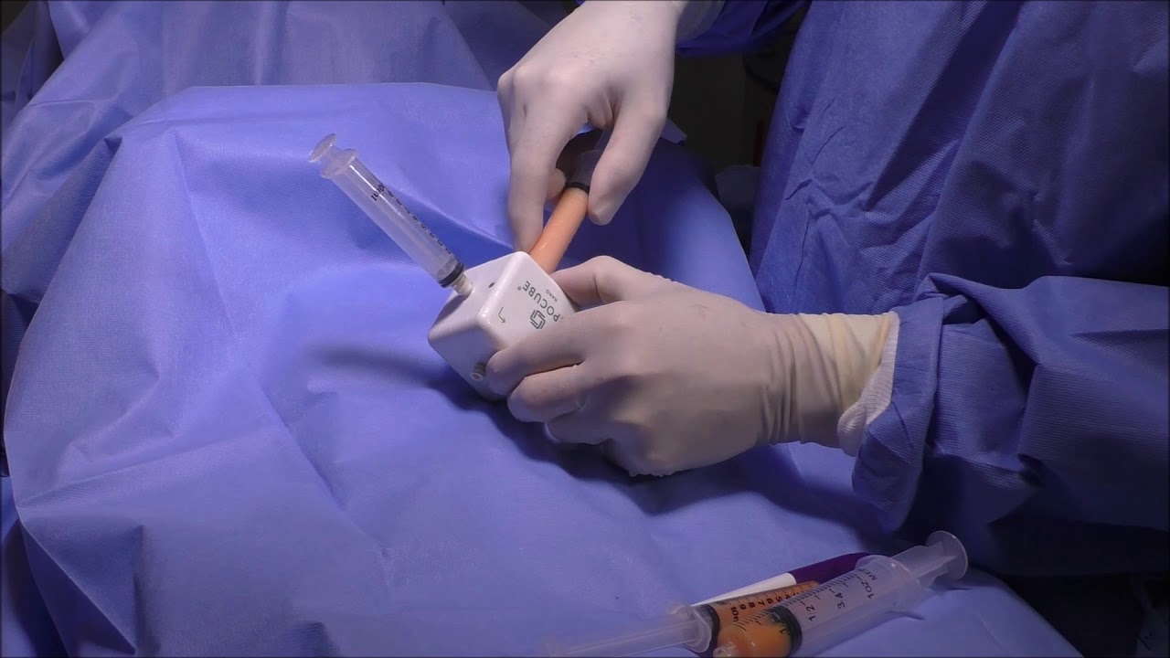 Make your biceps bigger with nanofat injections using the Lipocube ...