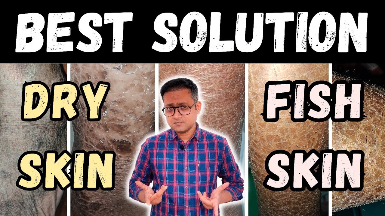 Dry skin in winter | Ichthyosis | Treatment | Hindi | Dr Supratim - YouTube