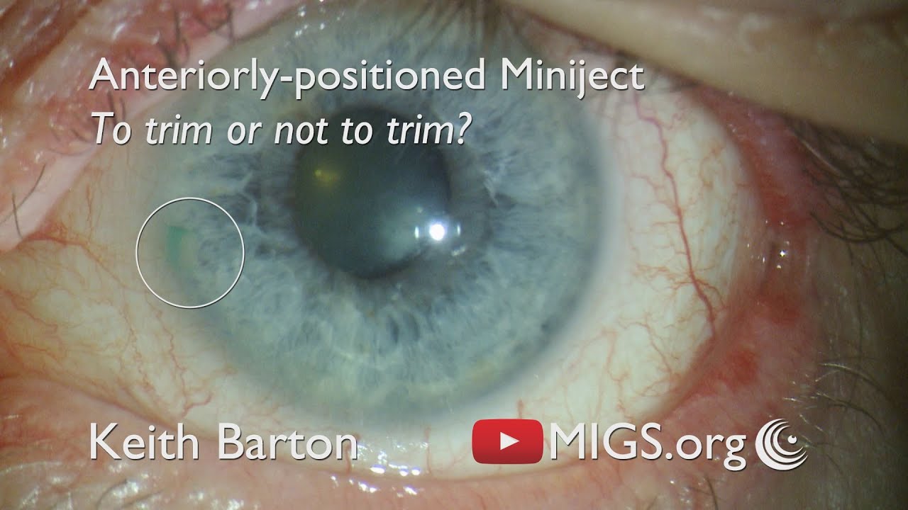 A Prominent Miniject. What to do? - YouTube
