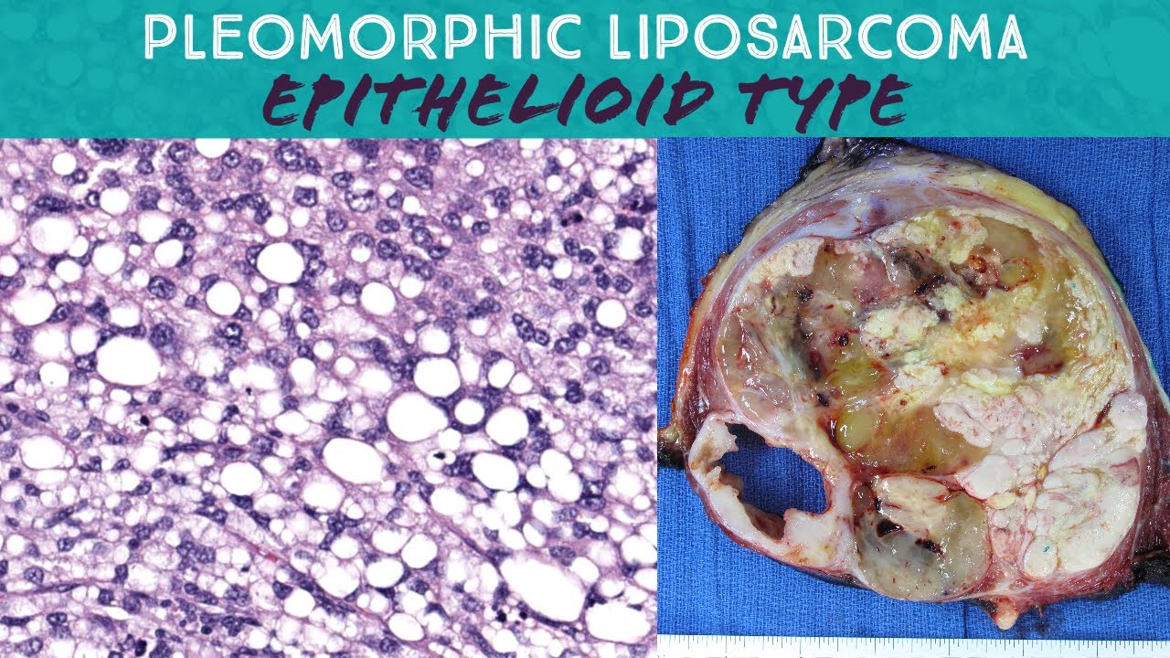 Liposarcoma