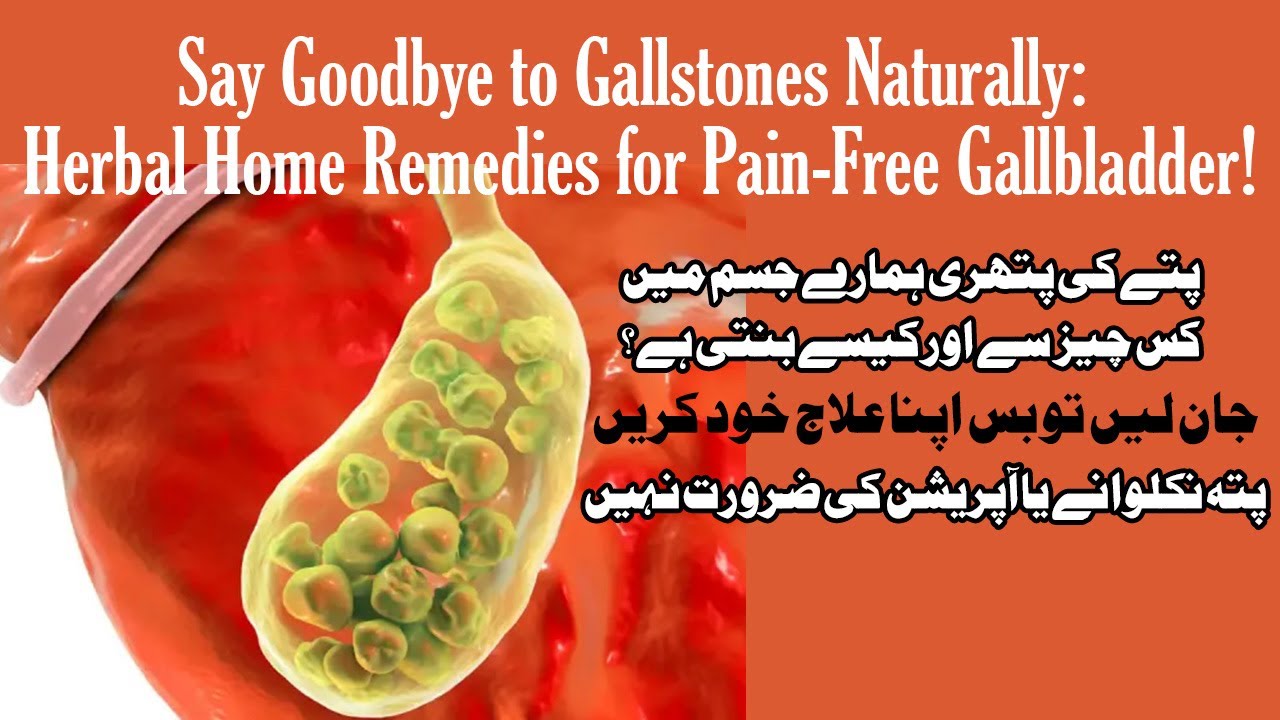 Say Goodbye to Gallstones Naturally: Herbal Home Remedies for Pain-Free ...