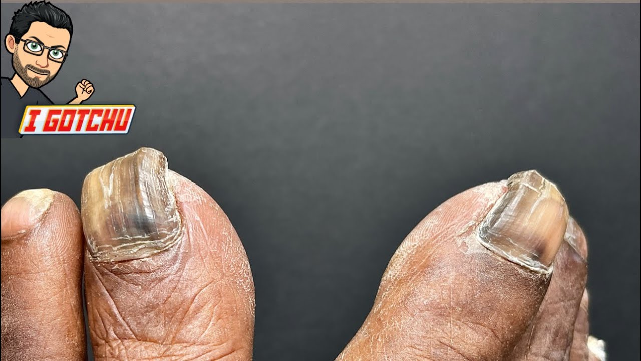 HELPING A HOMELESS TRIMMING HIS TOENAILS - YouTube