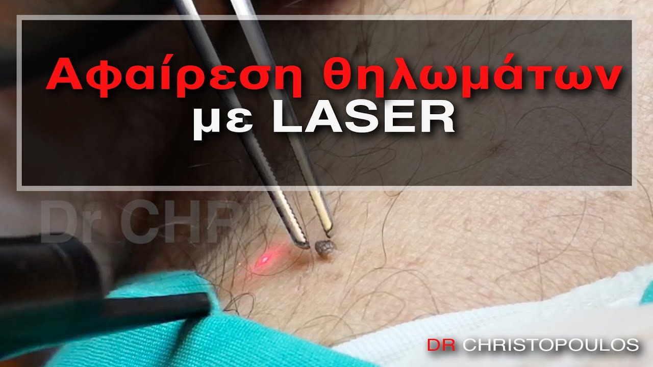 Αφαίρεση θηλωμάτων με LASER χωρίς σημάδι από πλαστικό χειρουργό - YouTube