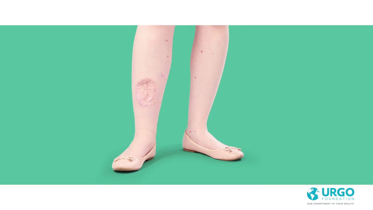 Legs Matter and the Urgo Foundation - Standing Up for Legs - YouTube