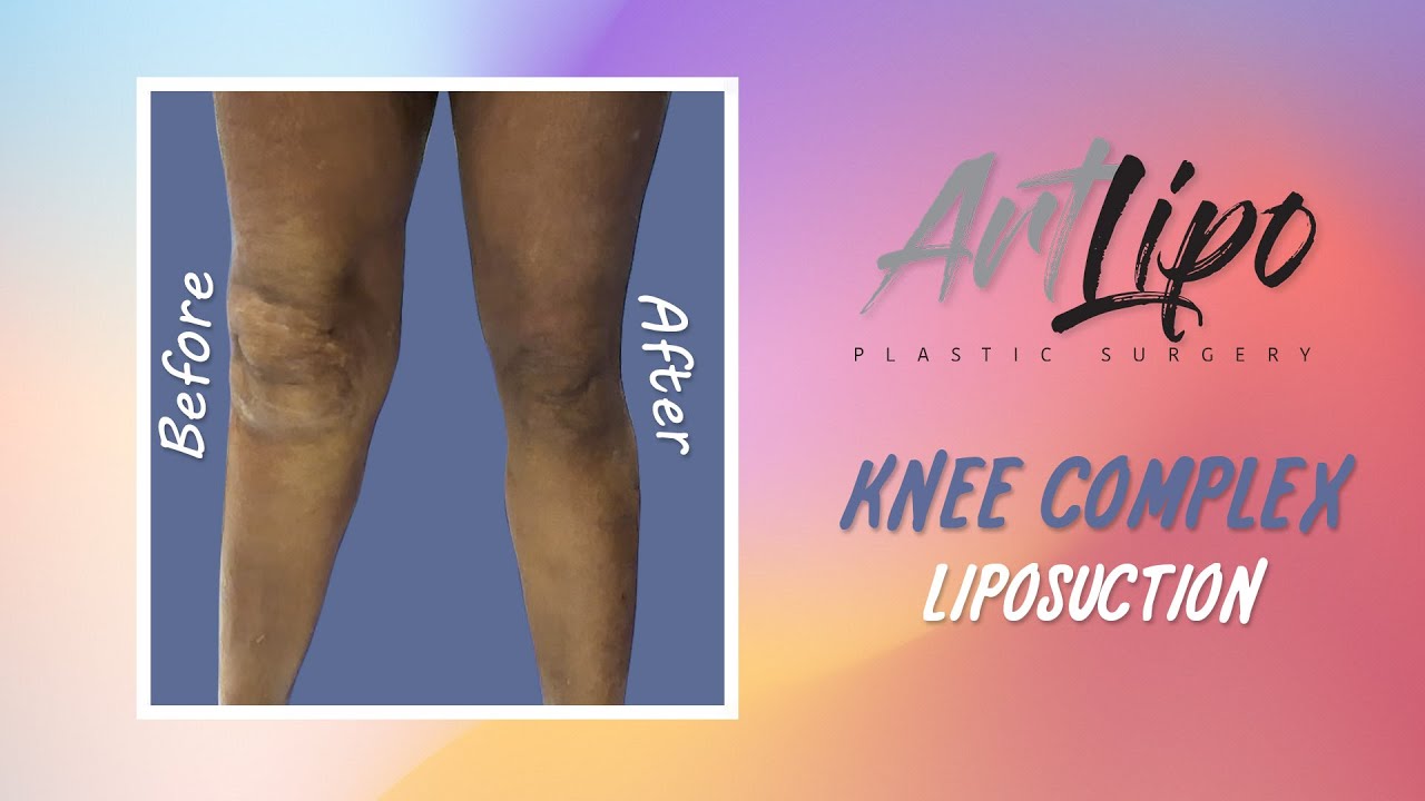 Liposuction Surgery | Knee Complex | Immediate Results | Expert Dr ...