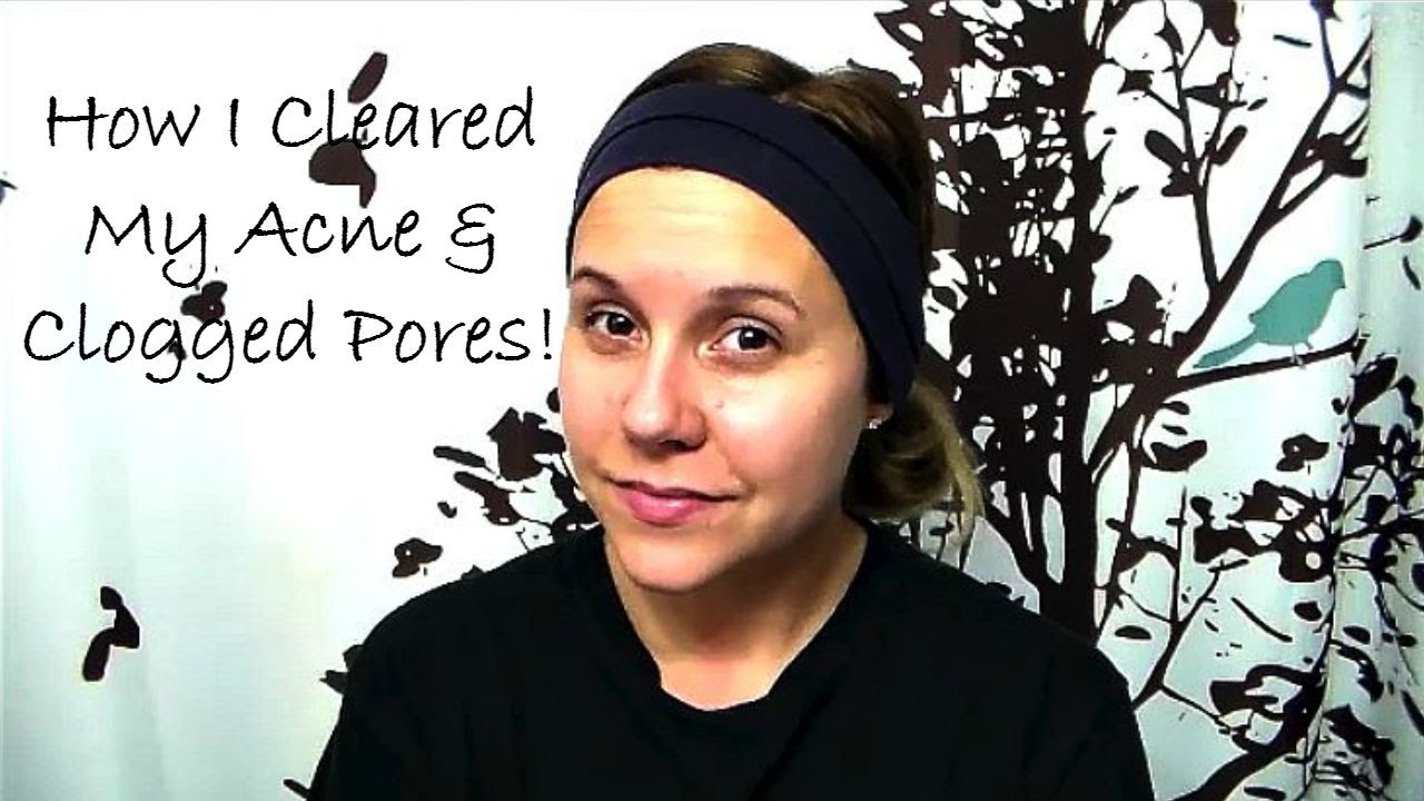 How I Got Rid Of My Acne | Congested & Clogged Pores - YouTube