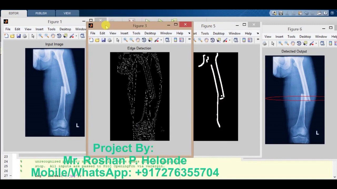 Bone Fracture Detection using Image Processing - YouTube