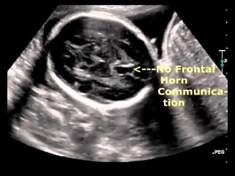 Septo-optic dysplasia - YouTube