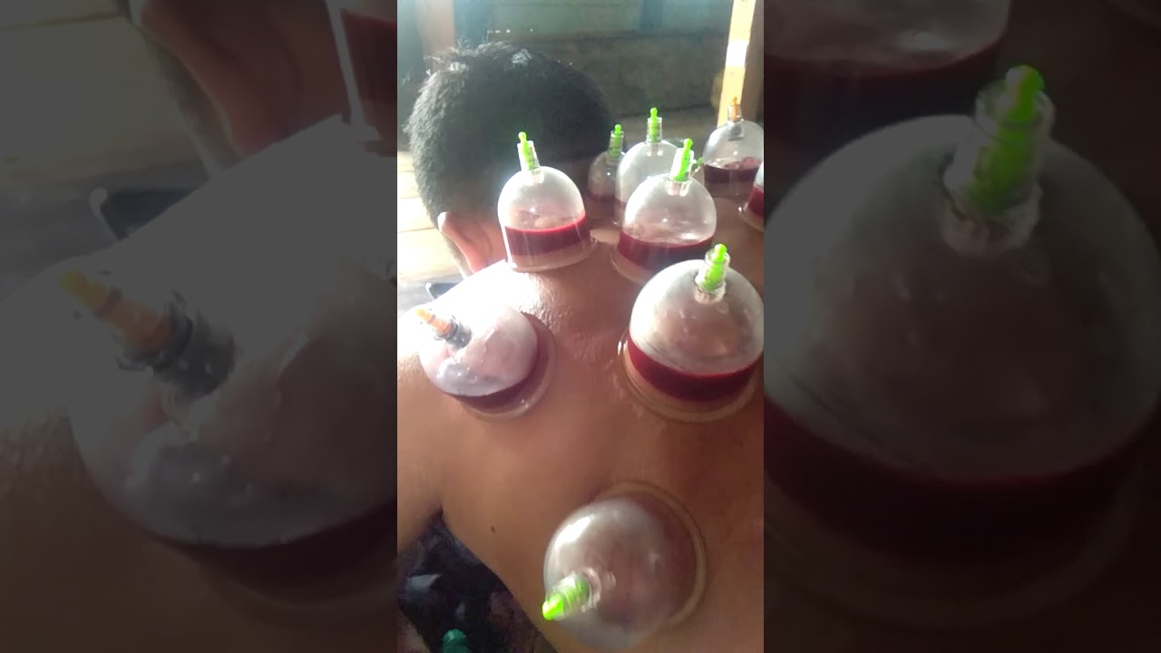 Bekam Kolestrol, Darah tinggi, gula darah, candu rokok. - YouTube