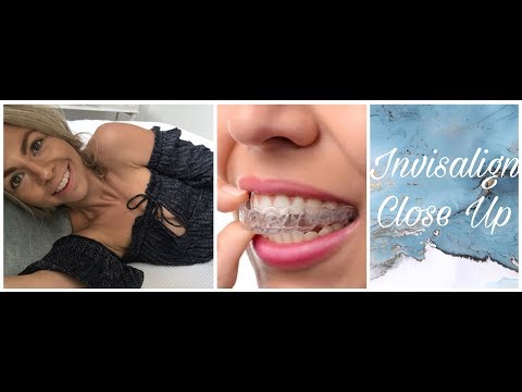 INVISALIGN PROGRESS - CLOSE UP OF MY TEETH