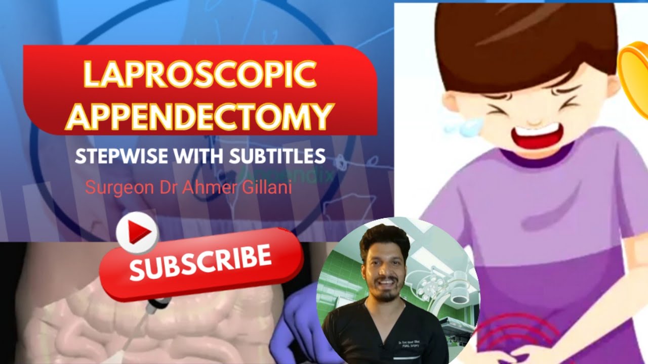 Laproscopic Appendectomy Stepwise Hd Video With Subtitles Port Position