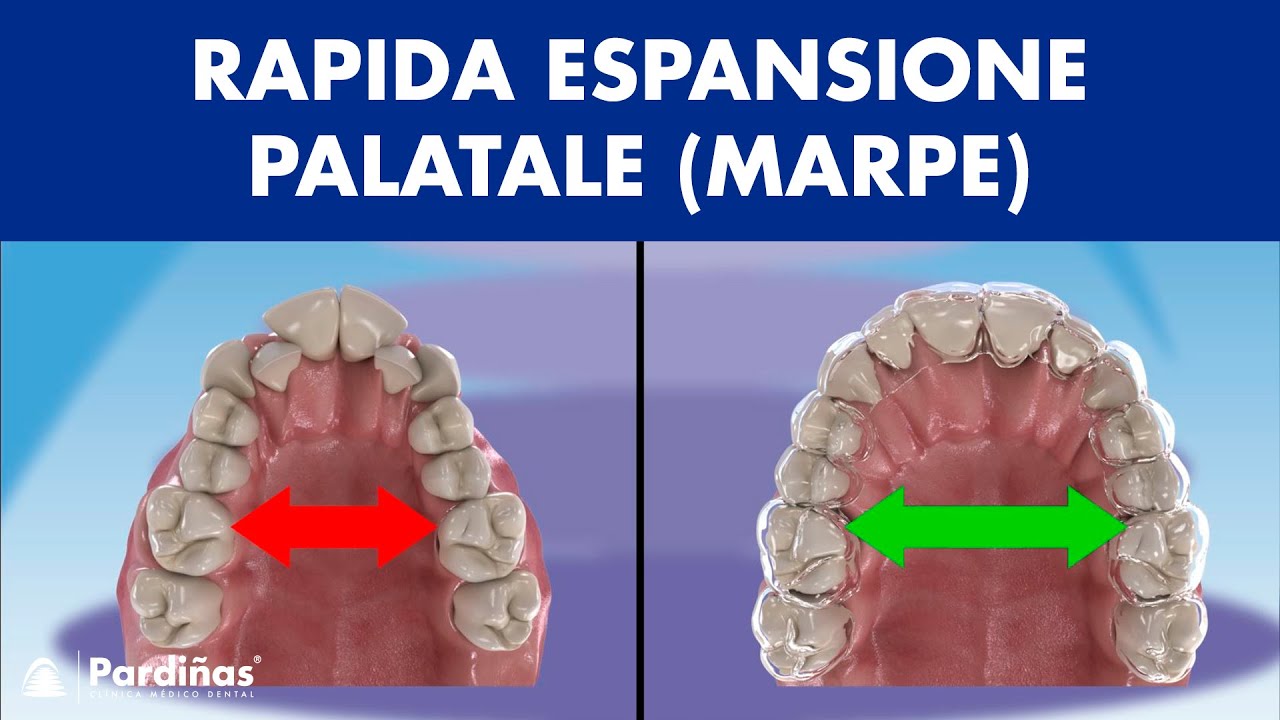 ESPANSIONE rapida del PALATO (MARPE) negli adulti © - YouTube