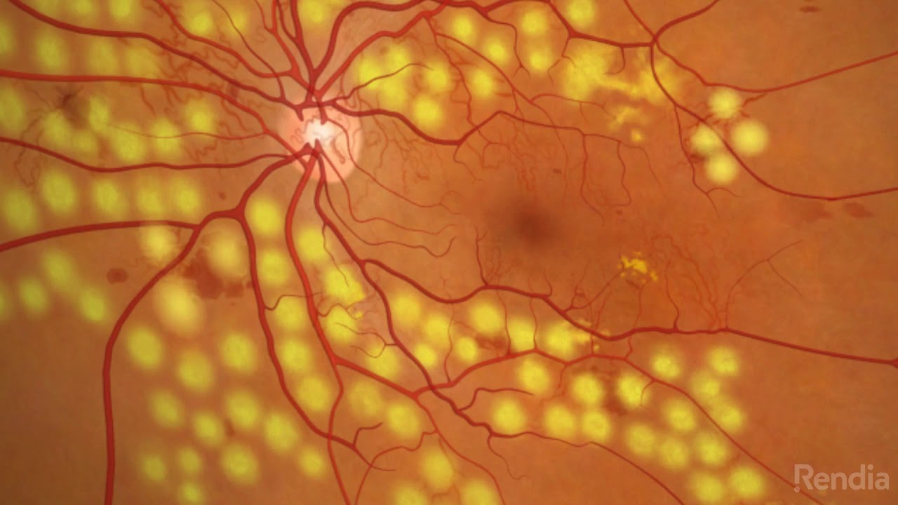 Diabetic Retinopathy Panretinal Photocoagulation - Diabetes