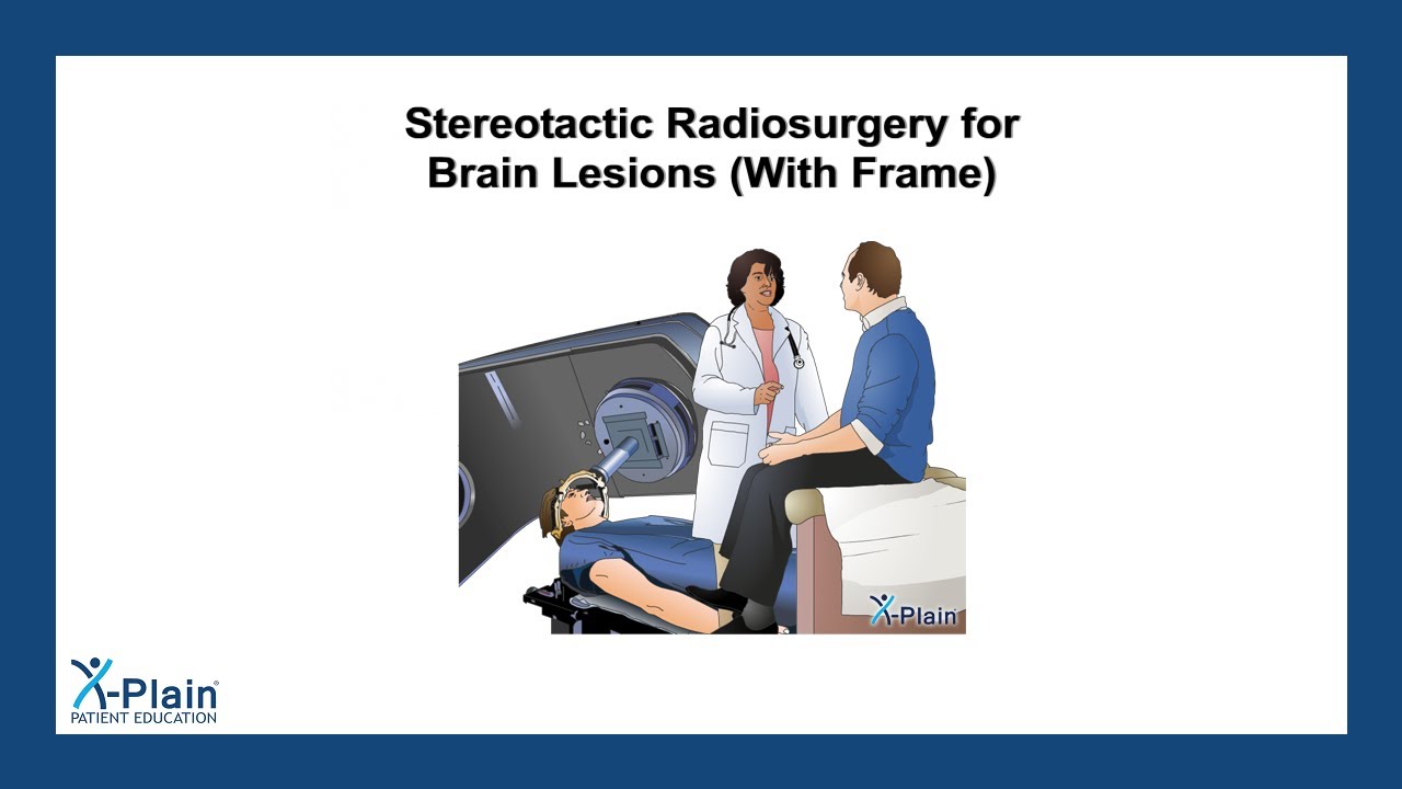 Stereotactic Radiosurgery for Brain Lesions (With Frame) - YouTube