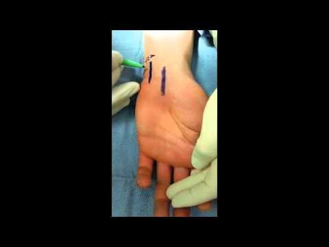 Wrist Block - YouTube