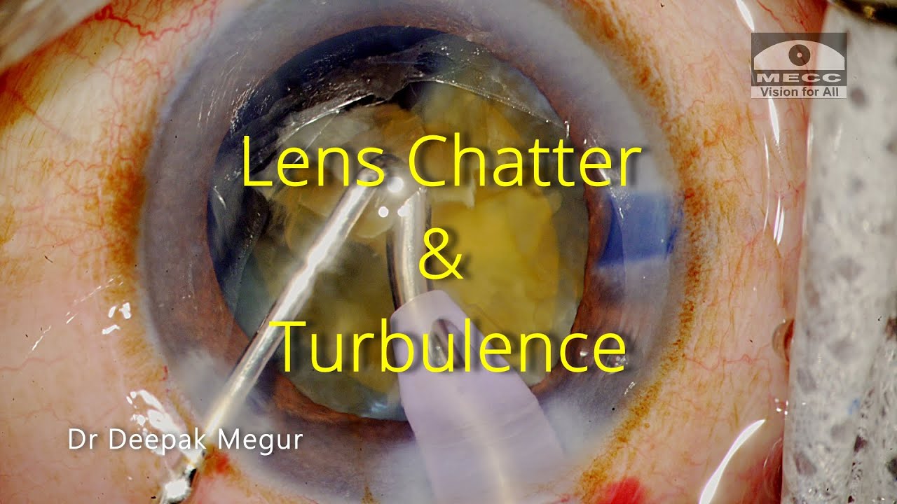 Lens Chatter and Turbulence during phacoemulsification- Let us analyze ...