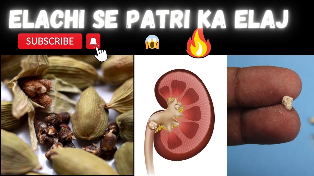 Gurde K Pathri Ka Elaj | Mint me Dard se Mile Nijat | Effective Home ...