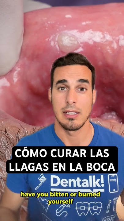 Cómo CURAR las LLAGAS, AFTAS o ÚLCERAS en la boca - Quemaduras y mordeduras en el labio y lengua ...