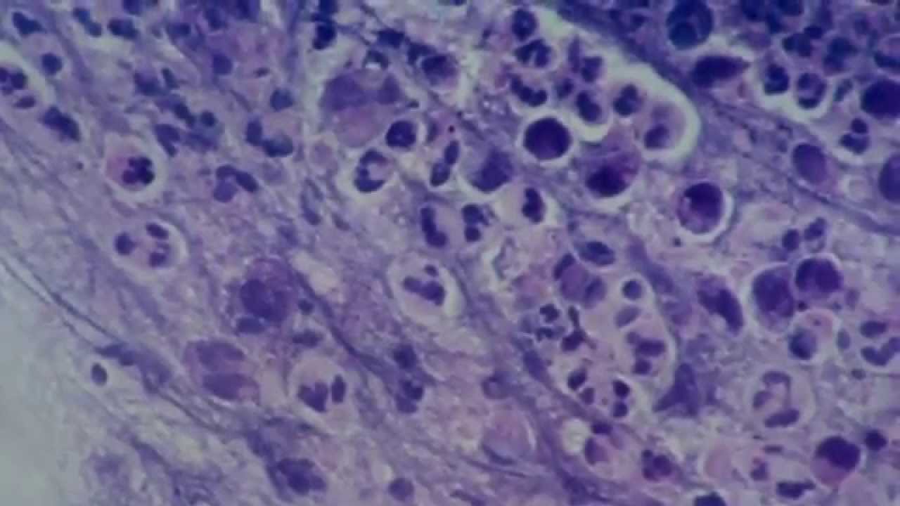 Dermatology. Boil (or furuncle). - YouTube
