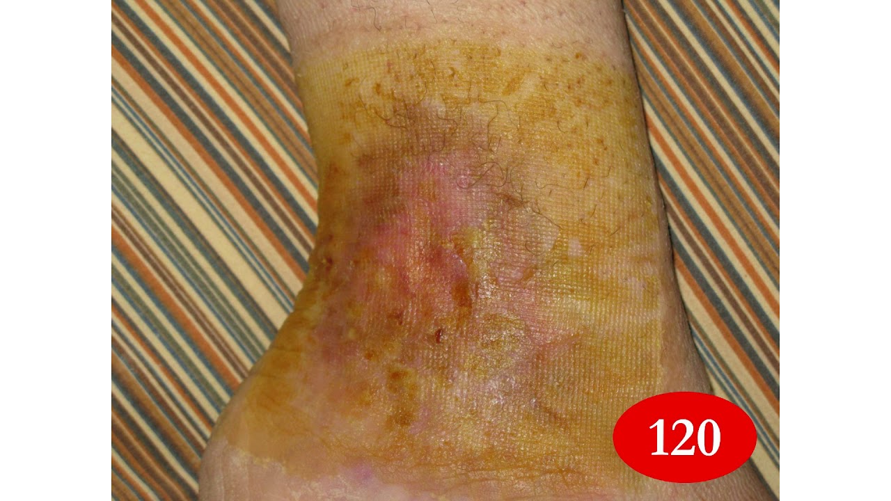 KADERMIN POWDER SPRAY - CÔNG NGHỆ PHÂN TỬ SCX (DÙNG CHỮA LÀNH CÁC VẾT ...