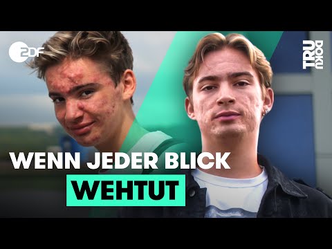Tom (22): Hautprobleme haben mein Leben bestimmt | TRU DOKU